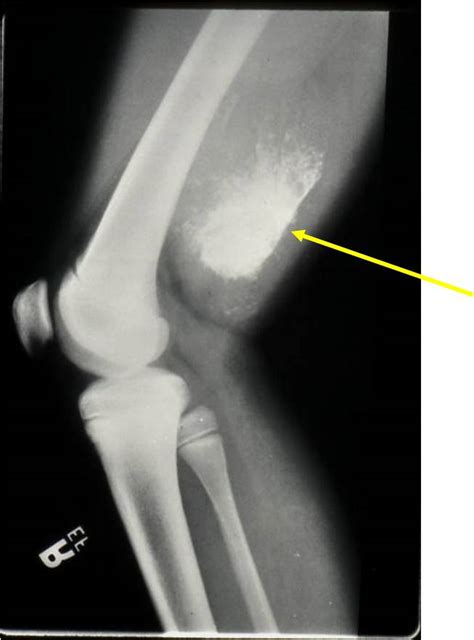 Mesenchymal Chondrosarcoma Tumor Surgery Network