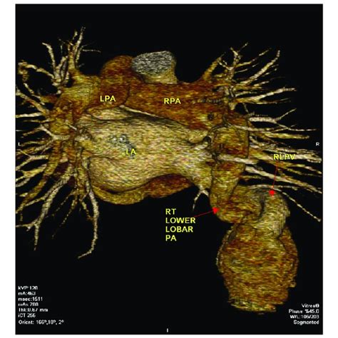 Multidetector Computed Tomography Angiography Of The Heart And Great Download Scientific