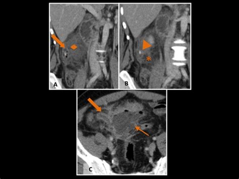 Acute Appendicitis Coronal A And B CT Scans Show A Fluid Filled Download Scientific Diagram