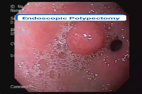 Parash Ullah On Linkedin Endoscopic Polypectomy At Tangail