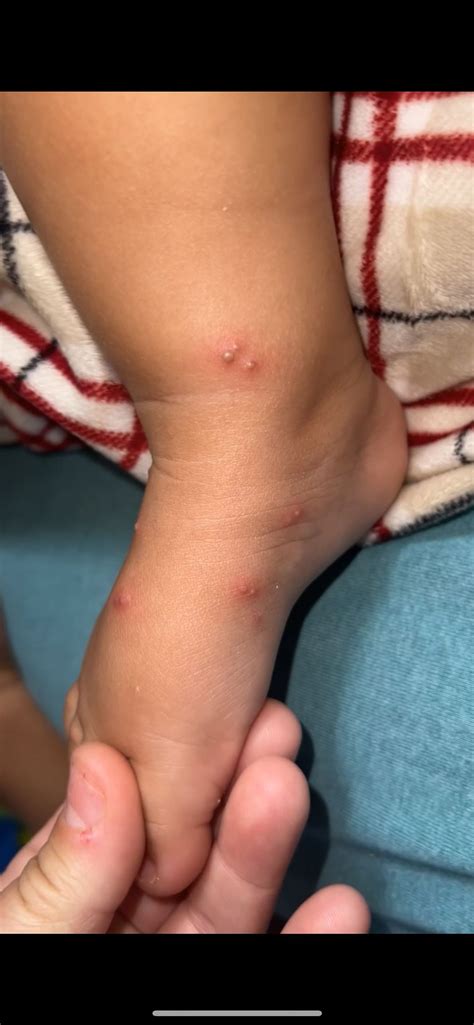 Fluid Puss Filled Bumps BabyCenter