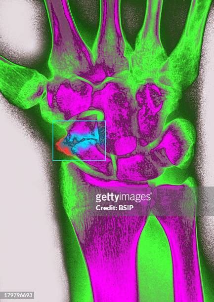 Hypertrophic Pseudarthrosis Photos And Premium High Res Pictures