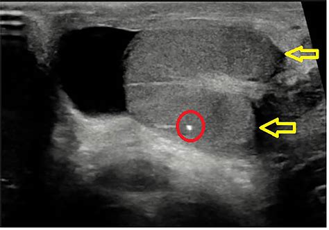 Testicular Choriocarcinoma Ultrasound