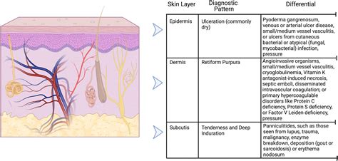 Calciphylaxis Part I Diagnosis And Pathology Journal Of The