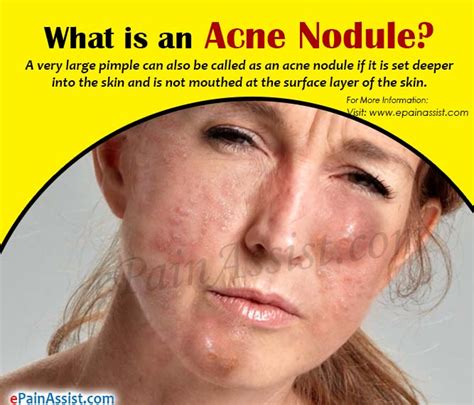 What Is An Acne Nodule