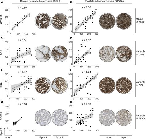 Multi Region Proteome Analysis Quantifies Spatial Heterogeneity Of Prostate Tissue Biomarkers