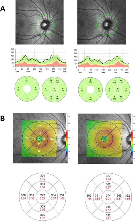 Representative Spectralis Sd Oct Scans Of A Retinal Nerve Fiber Layer Download Scientific