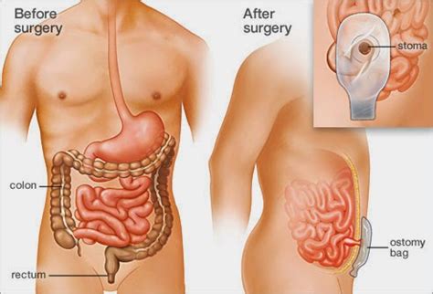Medical Treatment Pictures For Better Understanding Proctocolectomy Surgery Before After