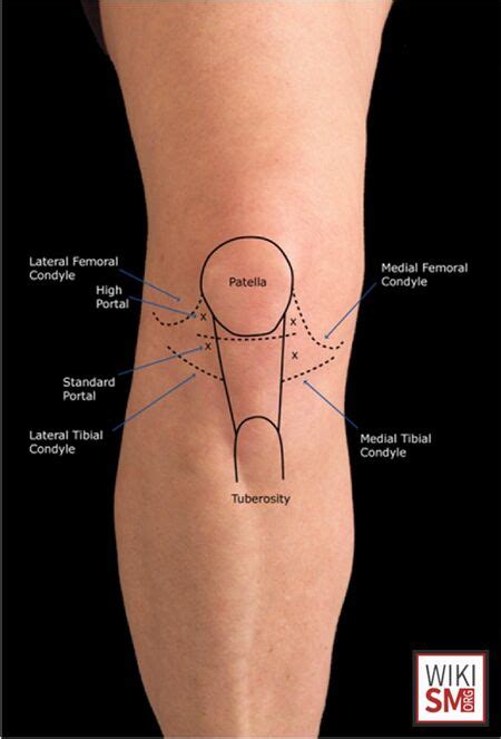 Hoffa Fat Pad Syndrome Wikism Sports Medicine Wiki