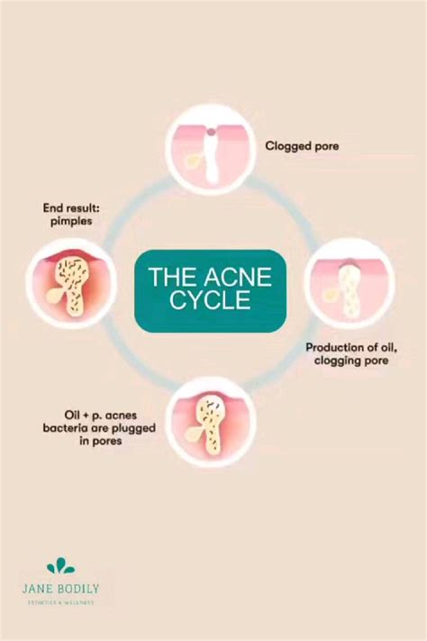 Knowing Acne Cycle Is Important To Prevent Them In Future Innit