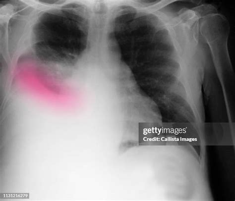 Pleural Diseases Photos And Premium High Res Pictures Getty Images