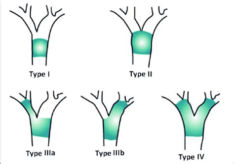 Types Of Hilar Tumors According To Bismuth Corlette S Classification