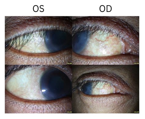 Conjunctival Xerosis