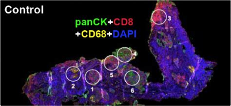 thin tissue slice of lung cancer digital signal processing adjacent