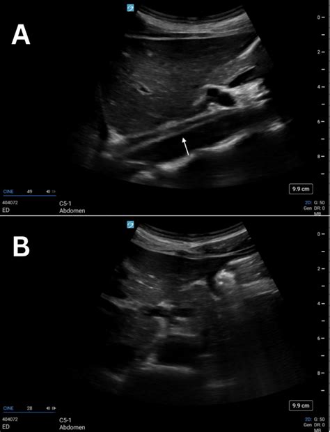 A Point Of Care Ultrasound Pocus Artifact Mimicking An Aortic