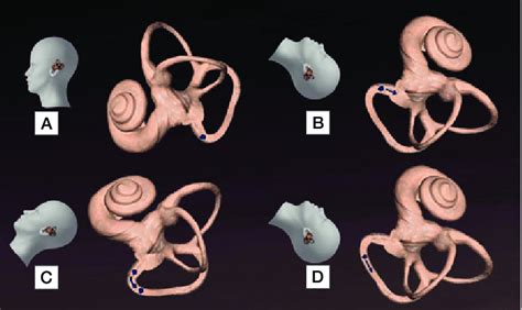 Our New Model For Some Forms Of Apogeotropic Posterior Canal Bppv