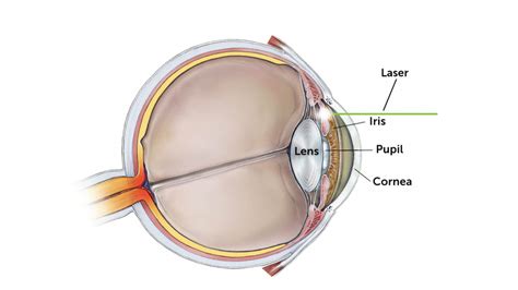 Laser Peripheral Iridotomy Surgery For Narrow Angle Glaucoma