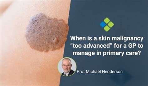 When Is A Skin Malignancy Too Advanced For A Gp To Manage