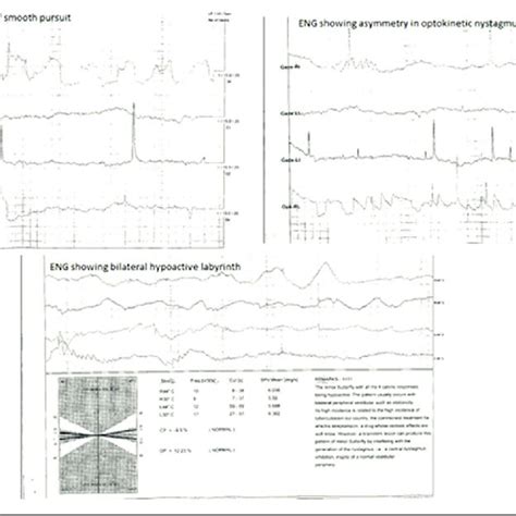 Eng Showing Saccadic Intrusions Of Smooth Pursuit Asymmetry Of Download Scientific Diagram