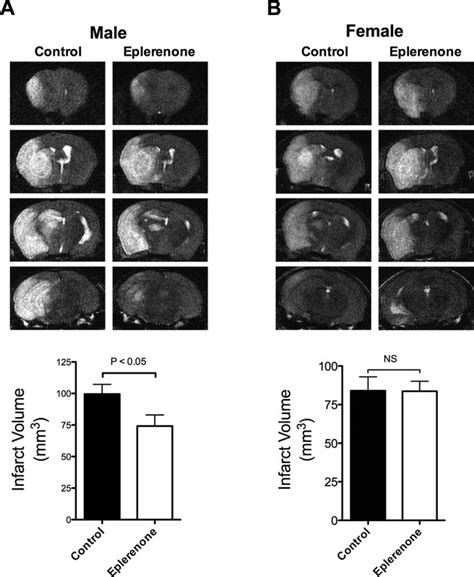 Myeloid Mineralocorticoid Receptor During Experimental Ischemic Stroke