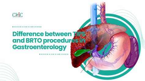 Differences Between Tips And Brto Procedures In Gastroenterology