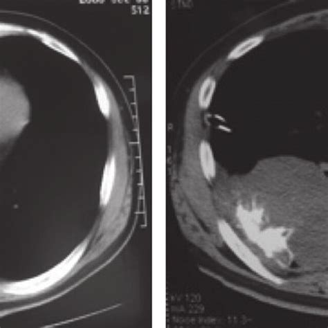 A Chest Ct Shows The Calcification In A Portion Of The Right Parietal Download Scientific