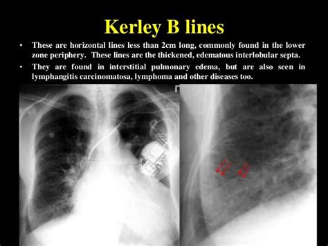 Kerley B Lines Pulmonary Edema