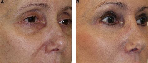 Periorbital Fat Grafting Facial Plastic Surgery Clinics