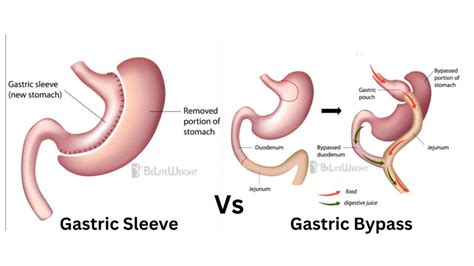 Gastric Sleeve Vs Gastric Bypass 10 Year Weight Loss