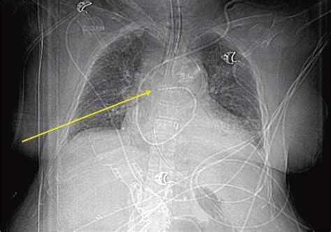 Pulmonary Artery X Ray