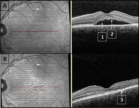 A Oct Of A Patient With 3 Months Duration Cscr Before Pdt Early