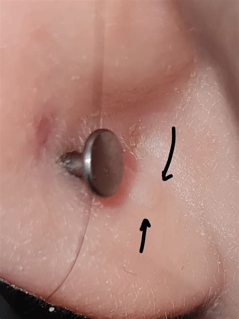 Cyst Vs Keloid Rdermatologyquestions