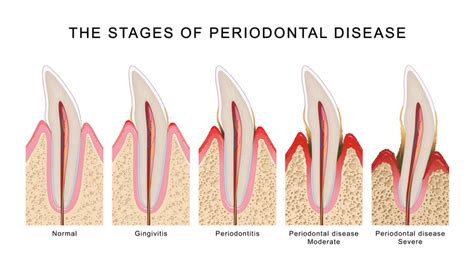Early Periodontitis Can Be Reversed