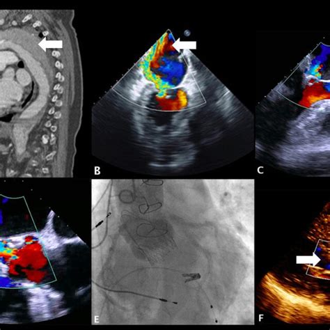 Sequential Percutaneous Approach For Severe Mitral And Aortic Valve