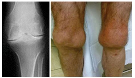 Hemostasis Bleeding Disorders Flashcards Quizlet