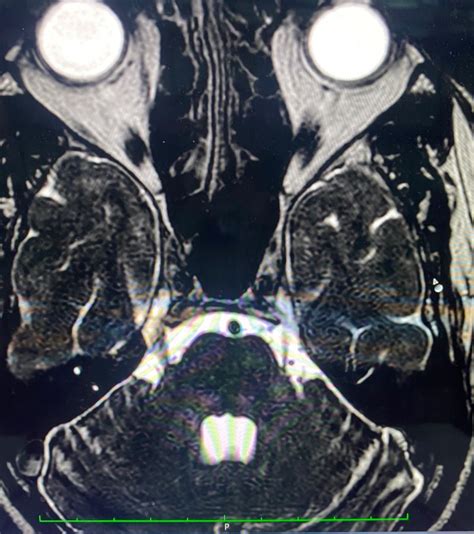 Dr Sonam Sanjay On Linkedin A Case Of Trigeminal Neuralgia On Left