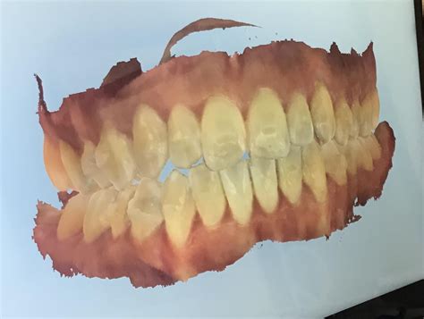 Refinement Scan Complete Rinvisalign