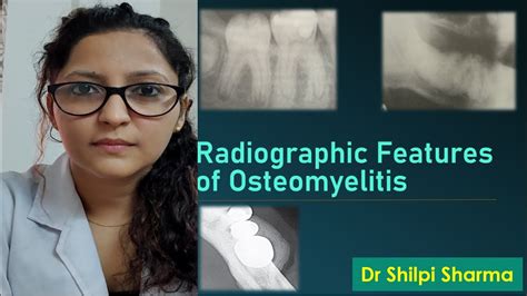 Diffuse Sclerosing Osteomyelitis