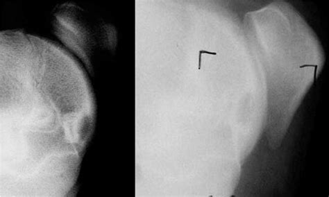 Radiological Examination After 12 Weeks Nearly Complete Resorption Of Download Scientific