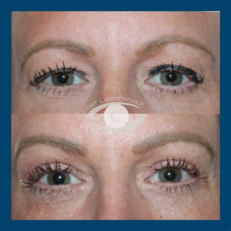 Upper And Lower Blepharoplasty Fort Lauderdale Eye Institute