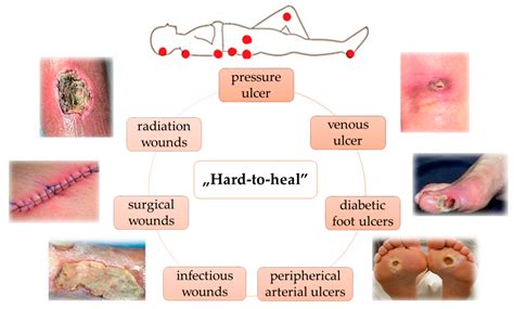 Modern Approaches In Wounds Management