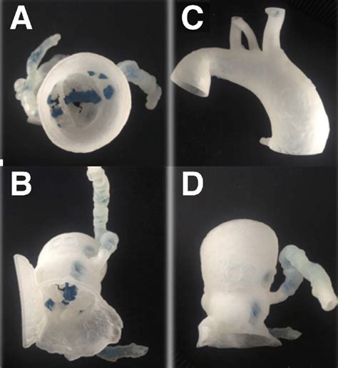 Three Dimensional Printed Models For Preoperative Planning