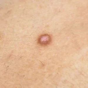 10 Common Skin Lumps With Pictures When To Worry And When To See A
