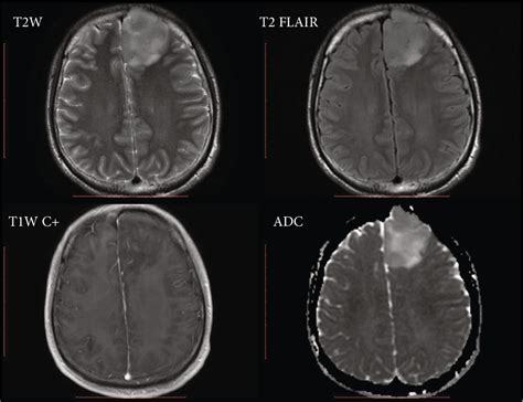 Figure 1 From Qualitative And Quantitative Mri Analysis In Idh1