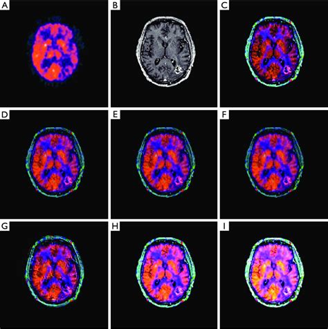 Spect And Mri Images A B Ihs Model C Lwt D Dwt E Pca F
