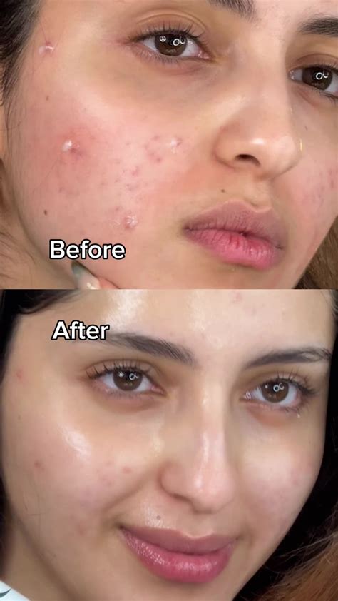 Best Panthenol Cream For Acne And Skin Barrier Repair Tiktok