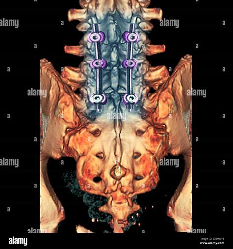 Fixed Spinal Fracture Coloured 3d Computed Tomography Ct Scan Of The Lumbosacral Spine Of A
