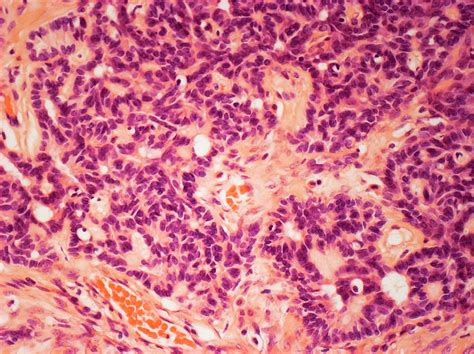 Ovarian Tumour By Science Photo Library