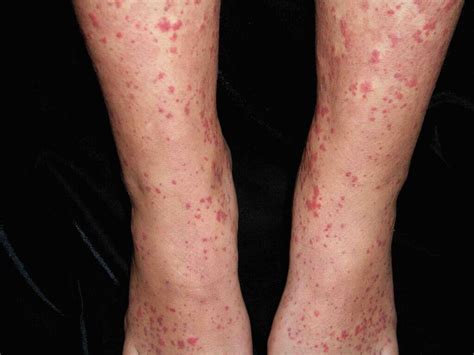 Iga Vaskulitis Im Erwachsenenalter Vielfältige Symptome Und