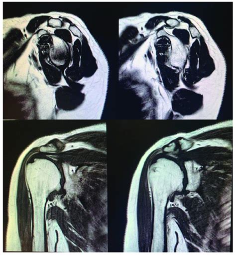 Pre Operative Magnetic Resonance Imaging To Evaluate The Integrity Of